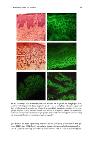 Autoimmune Diseases of the Skin_ Pathogenesis, Diagnosis, Management ...