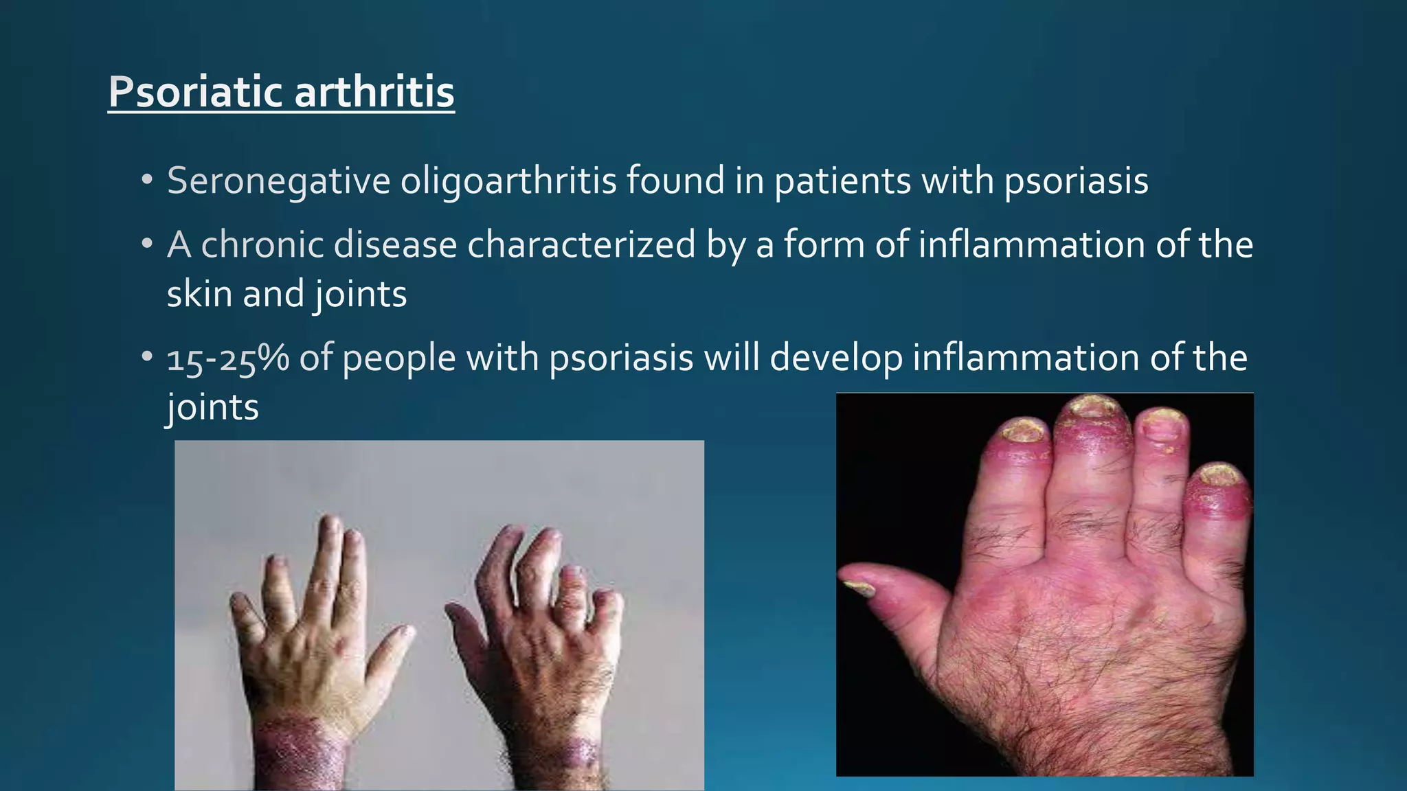 Autoimmune disorders | PPT
