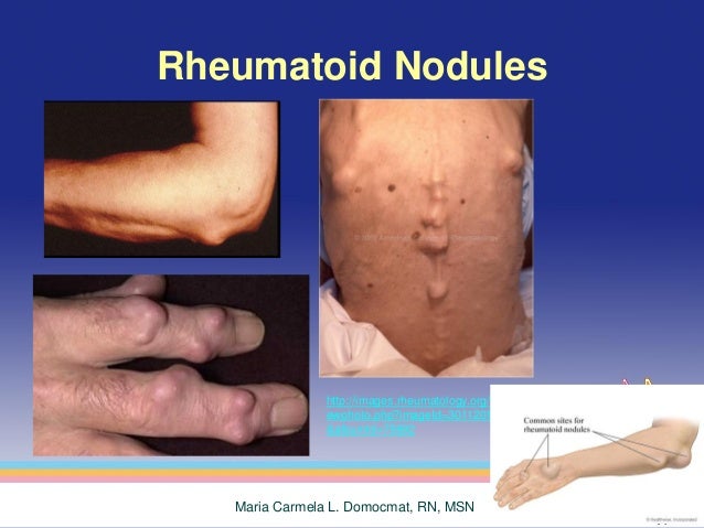 Rheumatic Disorders Part I