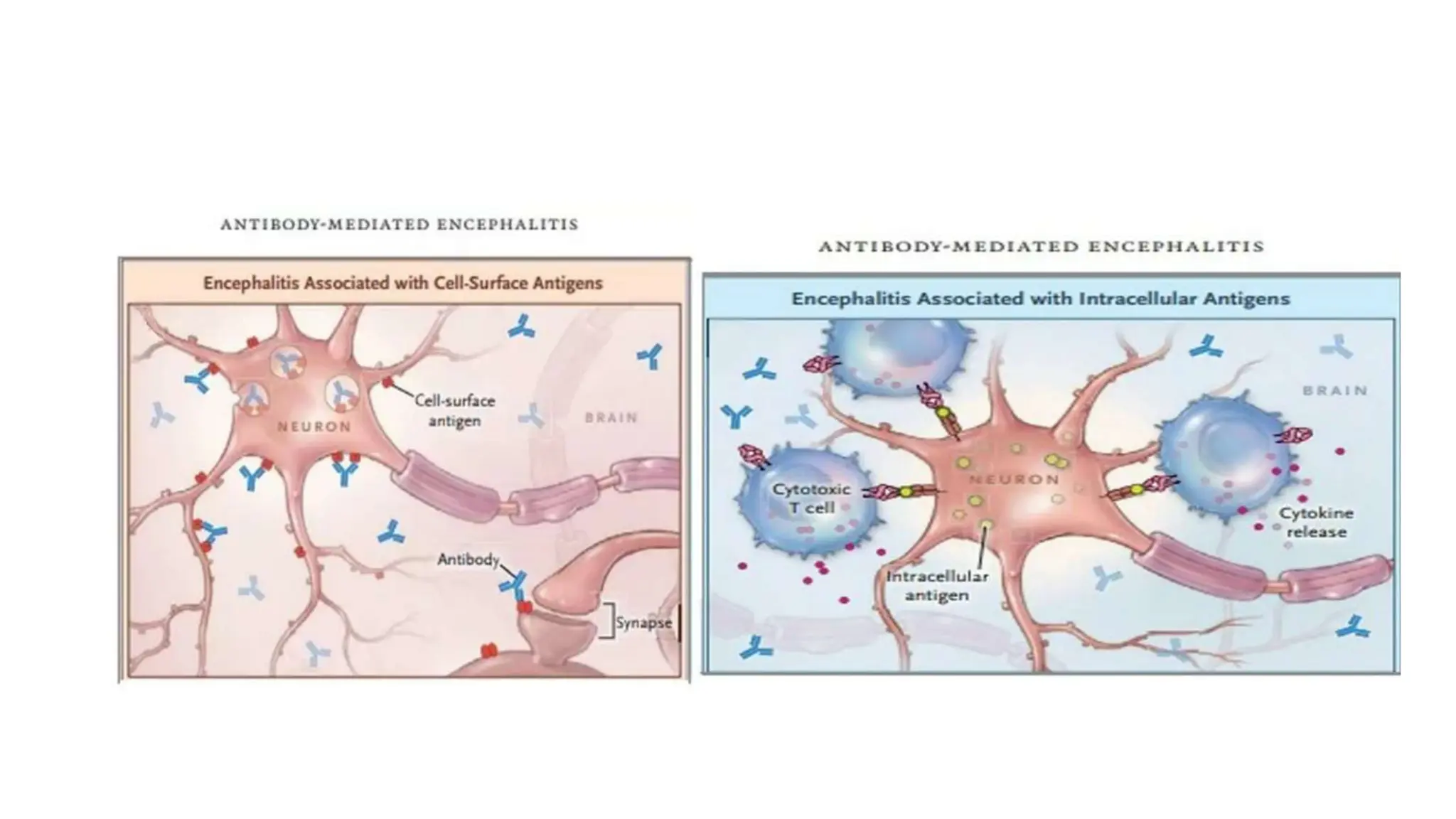 autoimmune encephalitis types, clinical features.pptx