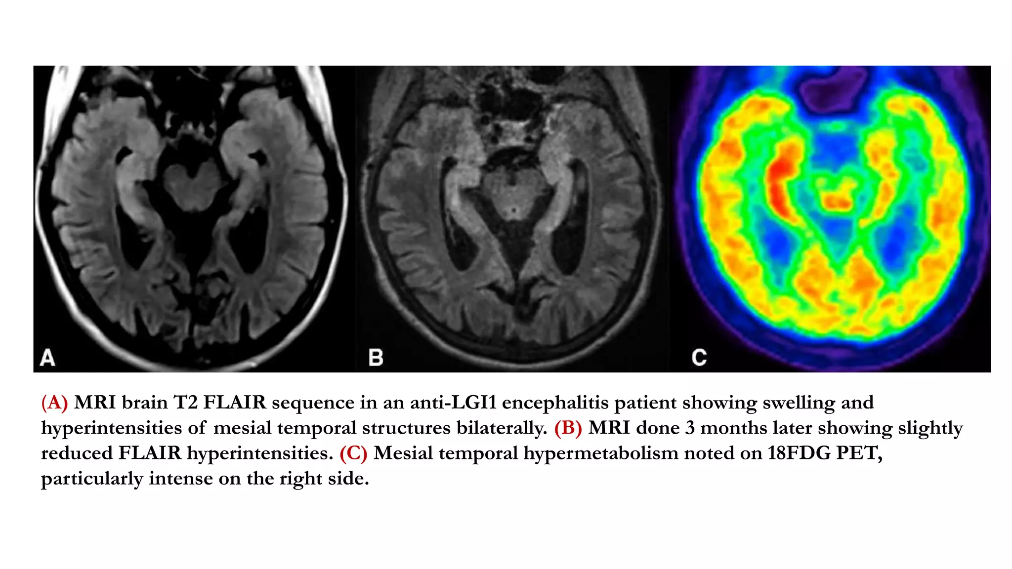 Autoimmune Epilepsies.pptx
