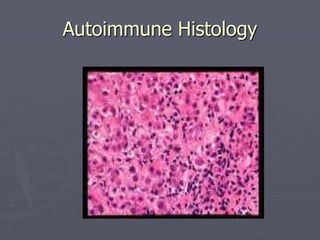 Autoimmune_Hepatitis.ppt pathologycomplete | PPT