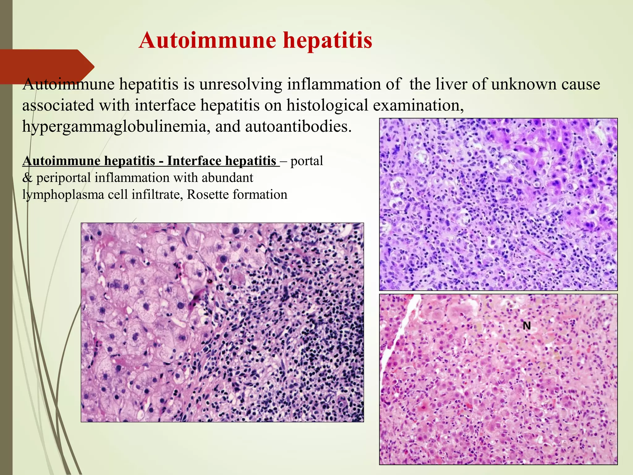 Autoimmune liver disease laboratory diagnosis | PPT