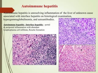 Autoimmune liver disease laboratory diagnosis | PPT