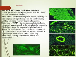 Autoimmune liver disease laboratory diagnosis | PPT