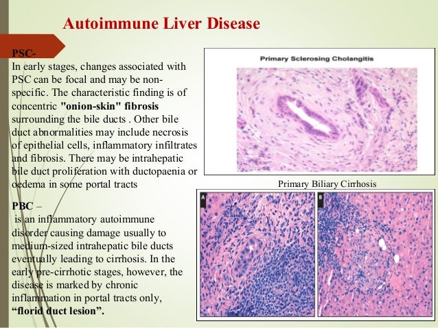 Autoimmune liver disease laboratory diagnosis