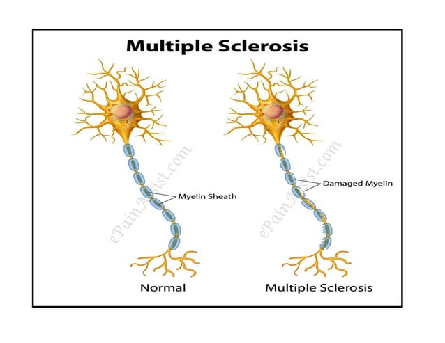 Autoimmune nervous system disorders | PDF | Brain and Nervous System ...