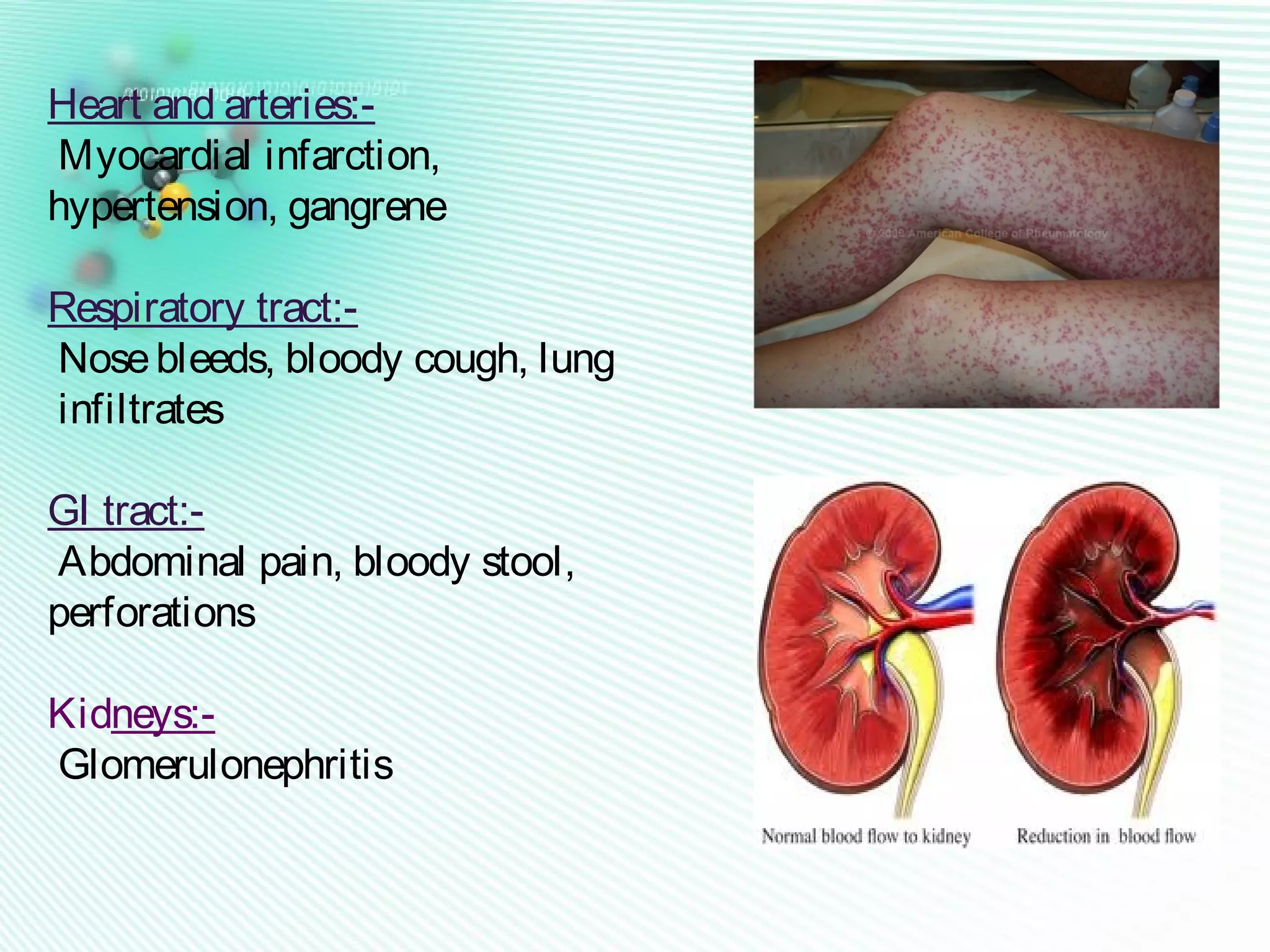 Auto immune vasculopathy and scleroderma ayurvedic perspective | PPT