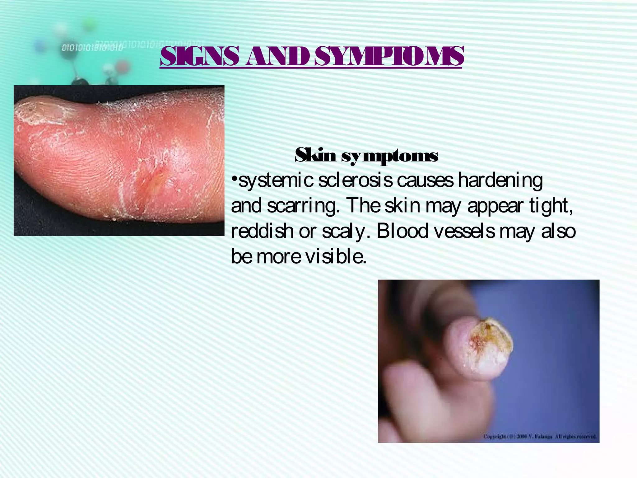 Auto immune vasculopathy and scleroderma ayurvedic perspective | PPT