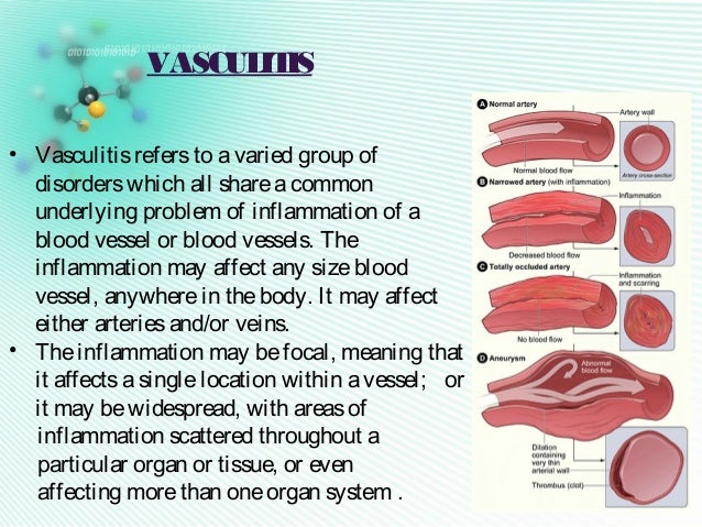 Auto immune vasculopathy and scleroderma ayurvedic perspective
