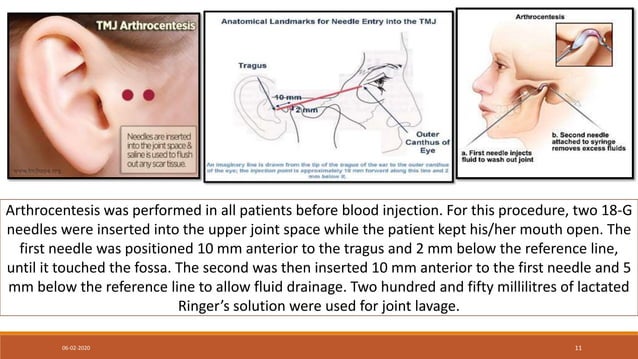Journal Club on Autologous blood injection for the treatment of ...