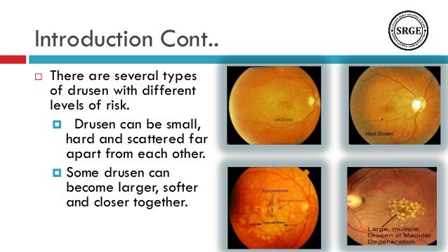 Automated drusen detection and quantificatioon system