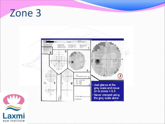 Automated perimetry | PPTX | Eye and Vision Conditions | Diseases and ...