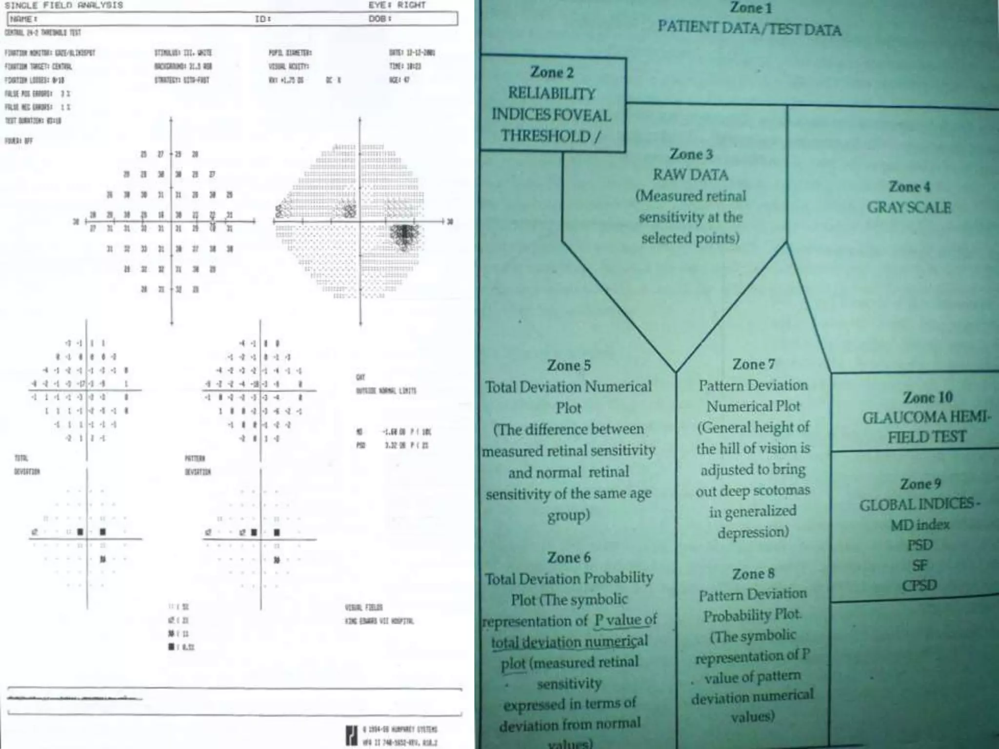 Automated perimetry | PPTX