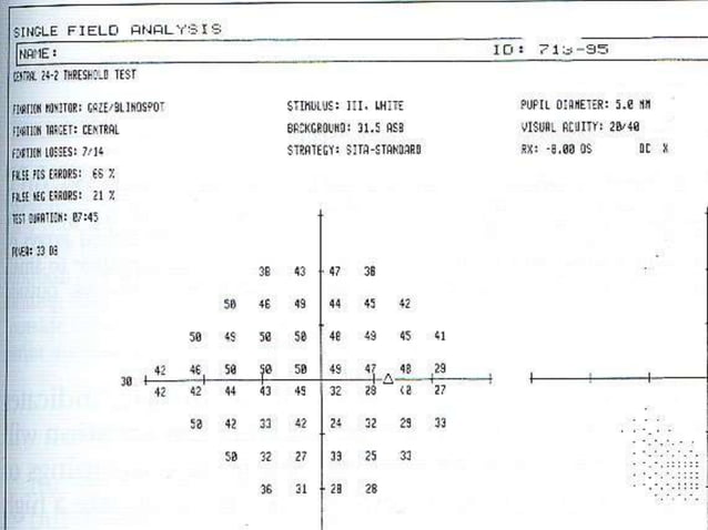 Automated perimetry | PPT