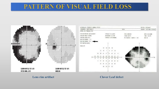 Automated Perimetry | PPT
