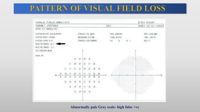 Automated Perimetry | PPT