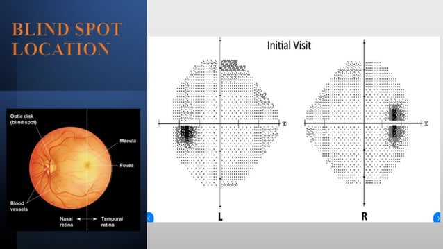 Automated Perimetry | PPT
