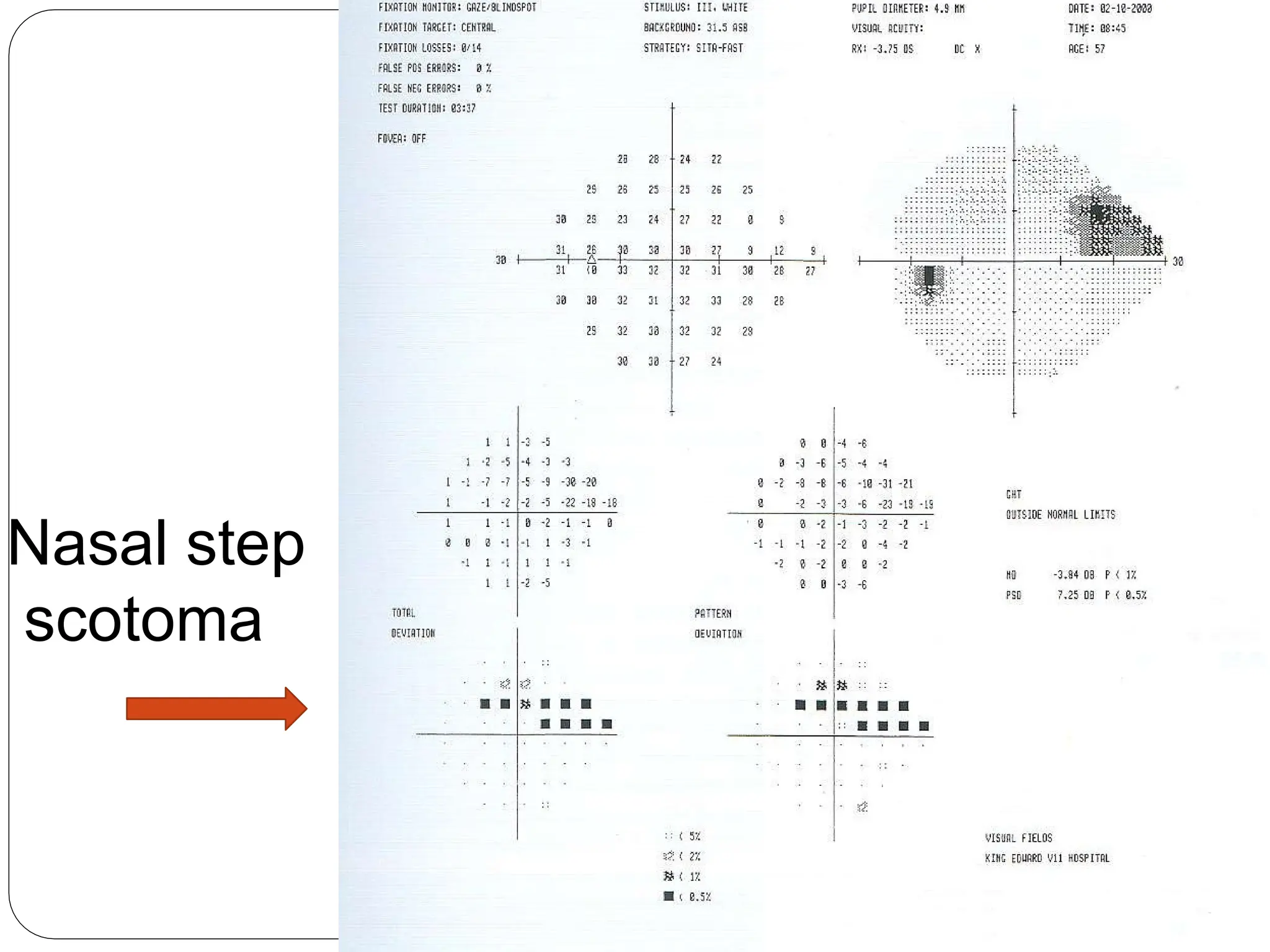 automated perimetry/ Humphrey's visual field.pptx