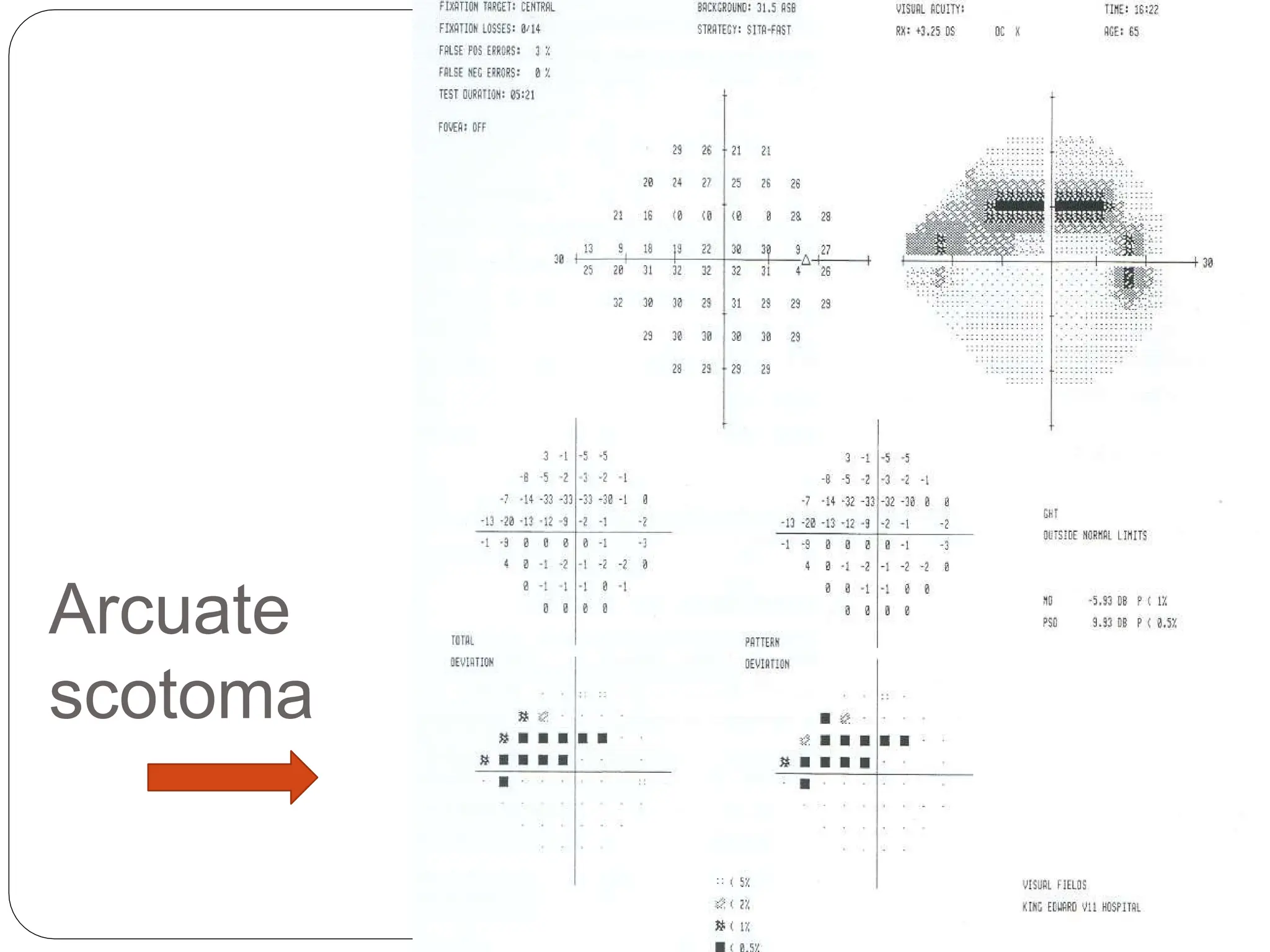 automated perimetry/ Humphrey's visual field.pptx