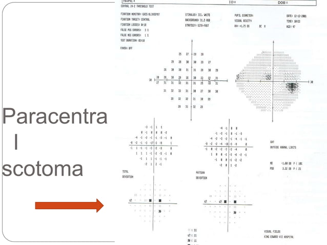 automated perimetry/ Humphrey's visual field.pptx