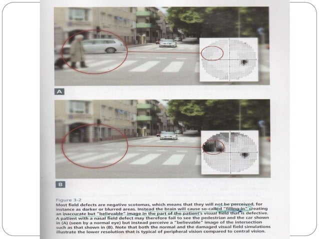 automated perimetry/ Humphrey's visual field.pptx
