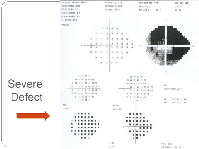 automated perimetry/ Humphrey's visual field.pptx