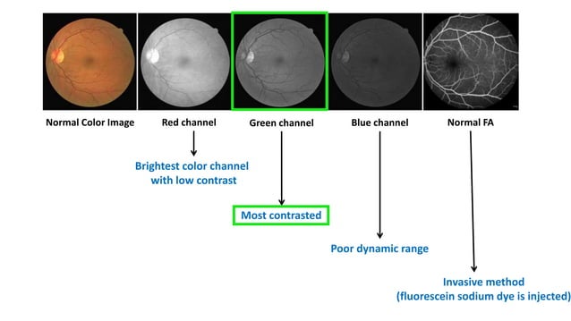 Automatic microaneurysm detection walter et. al. | PPT