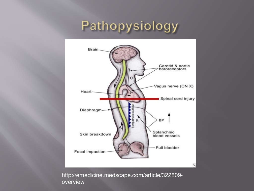 Autonomic dysreflexia in spinal cord injury