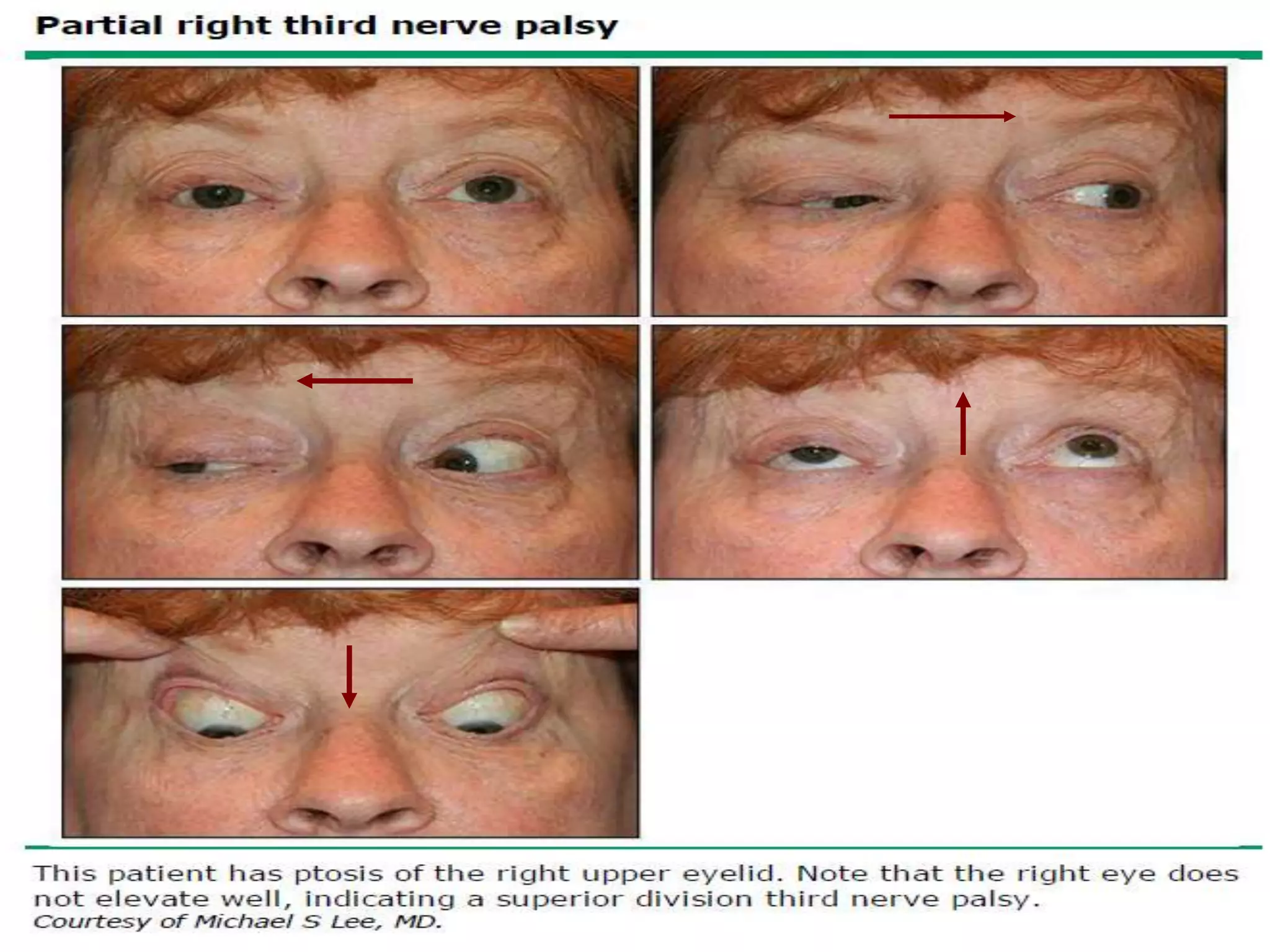 AUTONOMIC EYE PHENOMENA.pptx