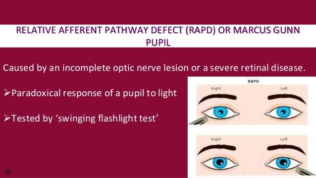 Autonomic innervation of ocular strucures and Pupillary reflexes