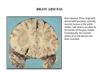 Autopsy-of-brain.pptx