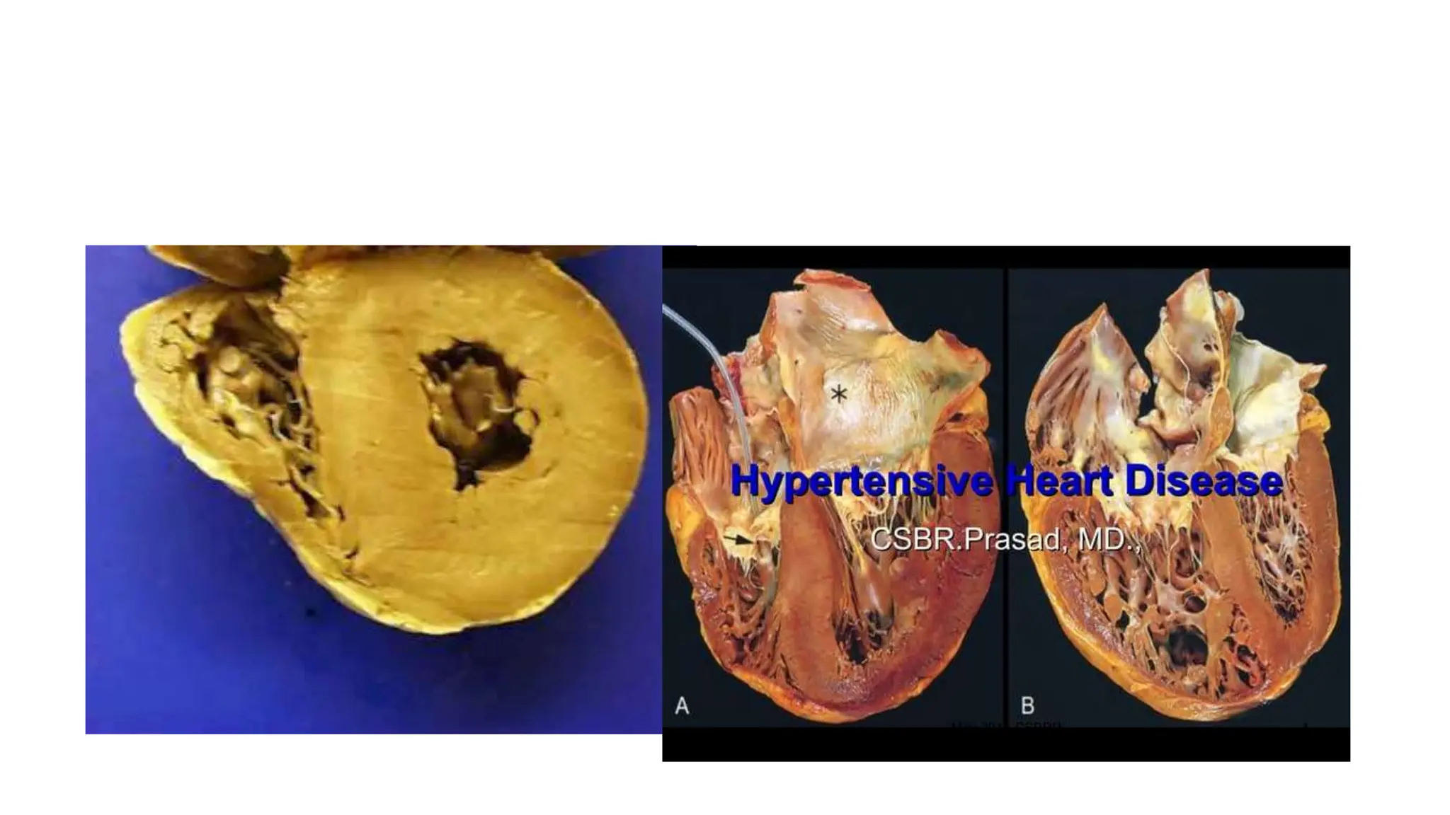 Autopsy Findings in Hypertensive Heart Disease.pptx