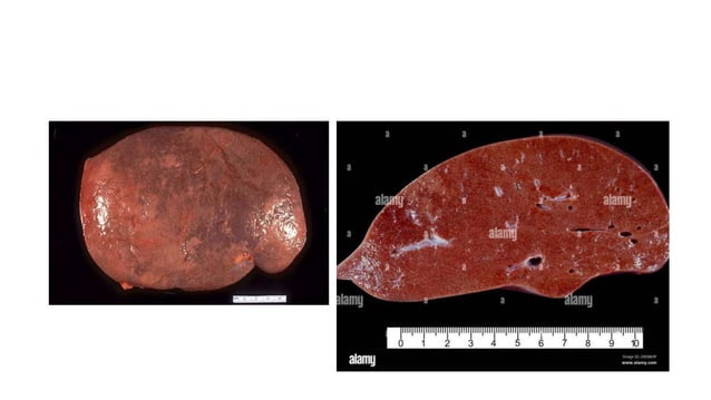 Autopsy Findings in Hypertensive Heart Disease.pptx