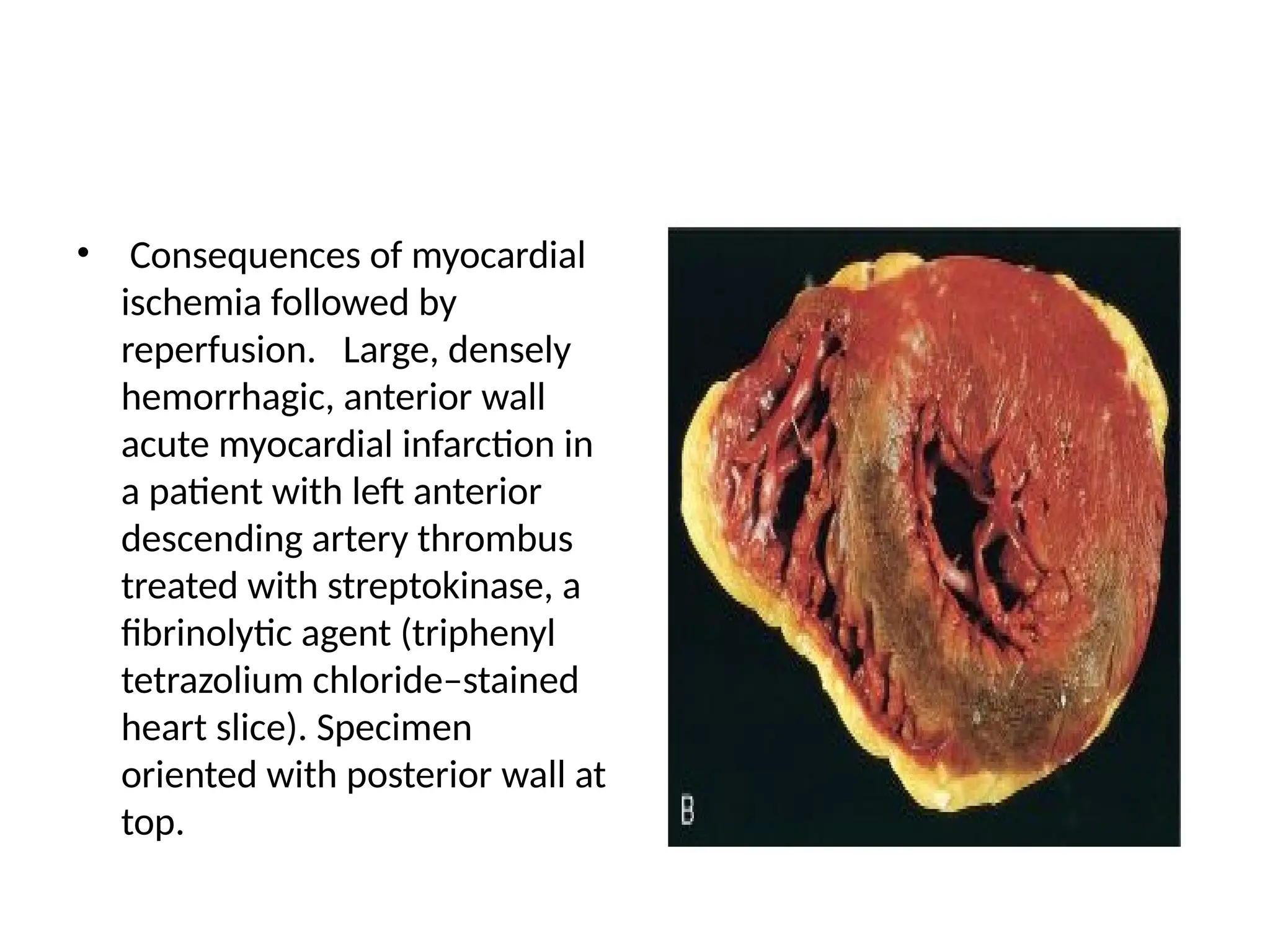 autopsy heart under forensic and investigation.pptx
