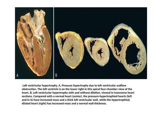 autopsy heart under forensic and investigation.pptx | Death, Injury, or ...