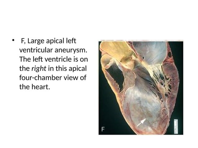 autopsy heart under forensic and investigation.pptx | Death, Injury, or ...