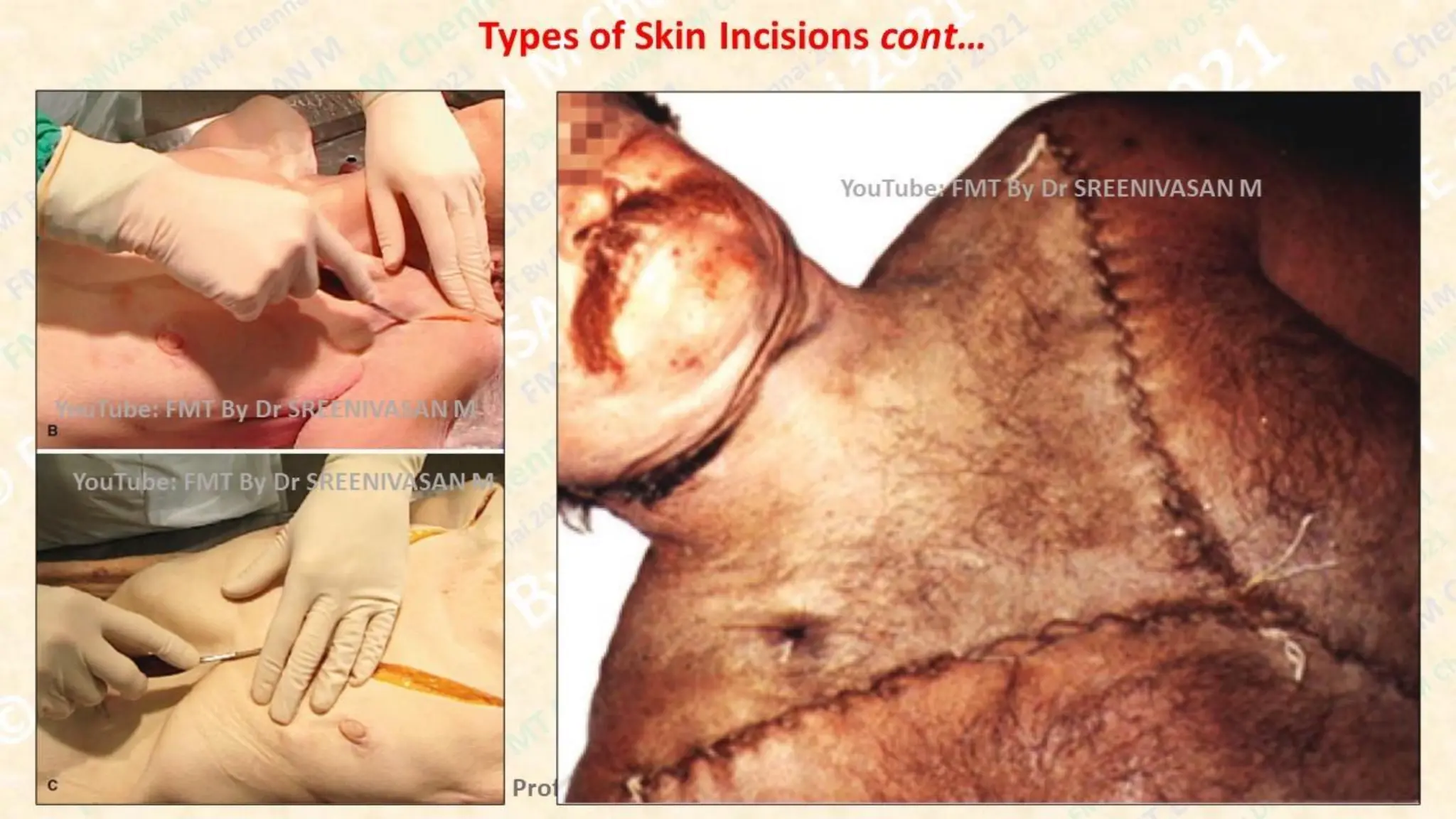 Types of Incisions in Autopsy and Methods of removal of organs | PDF