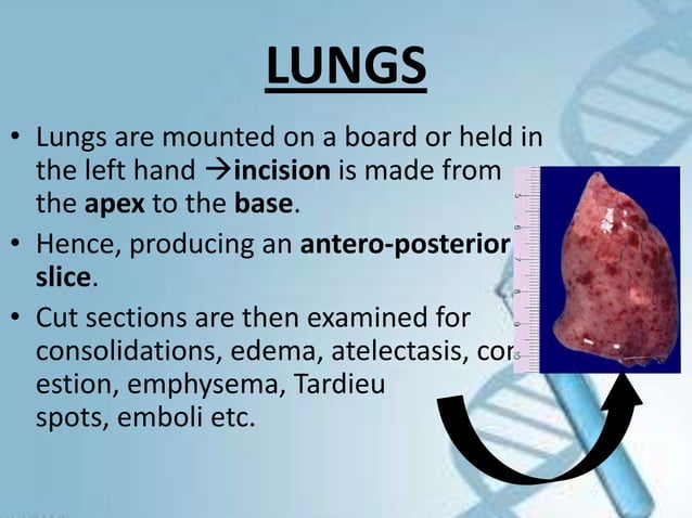 Autopsy internal examination, Forensic Medicine, Post-mortem ...