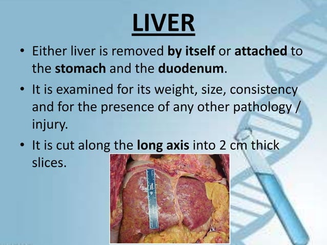 Autopsy internal examination, Forensic Medicine, Post-mortem ...
