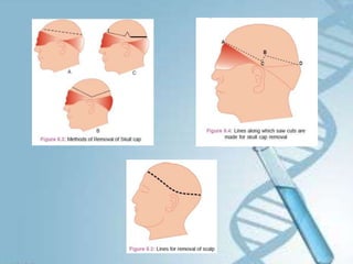 Autopsy internal examination, Forensic Medicine, Post-mortem ...
