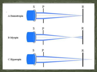 Autorefractometry: principle and procedure. | PPTX