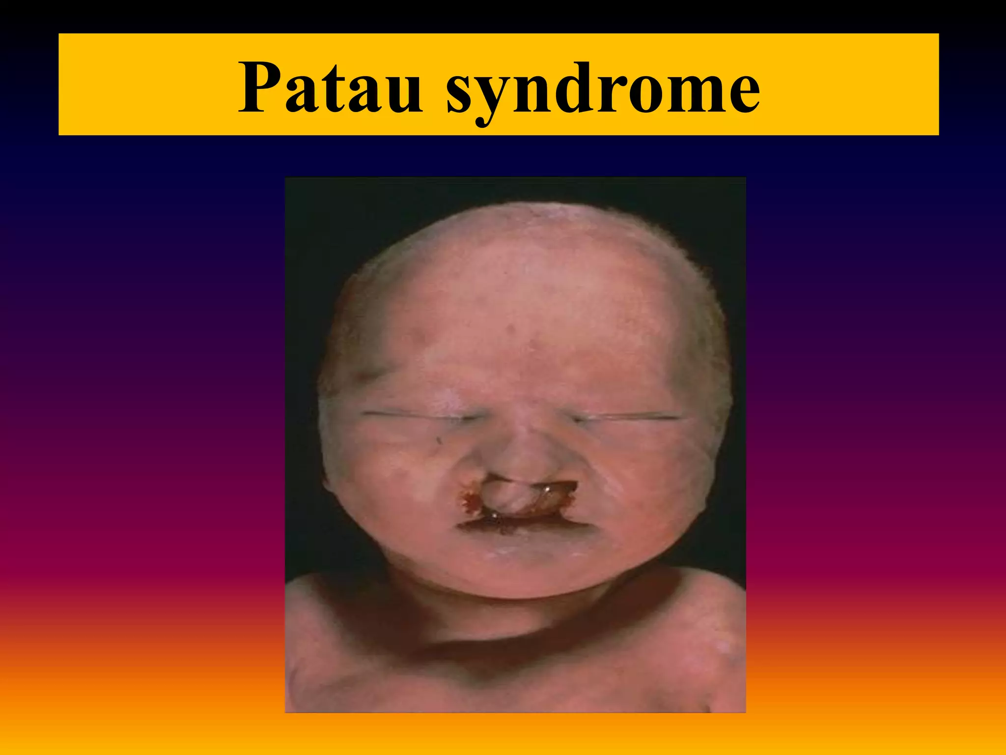 Autosomal Aberrations | PPTX