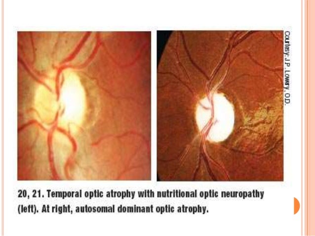 Autosomal dominant optic atrophy