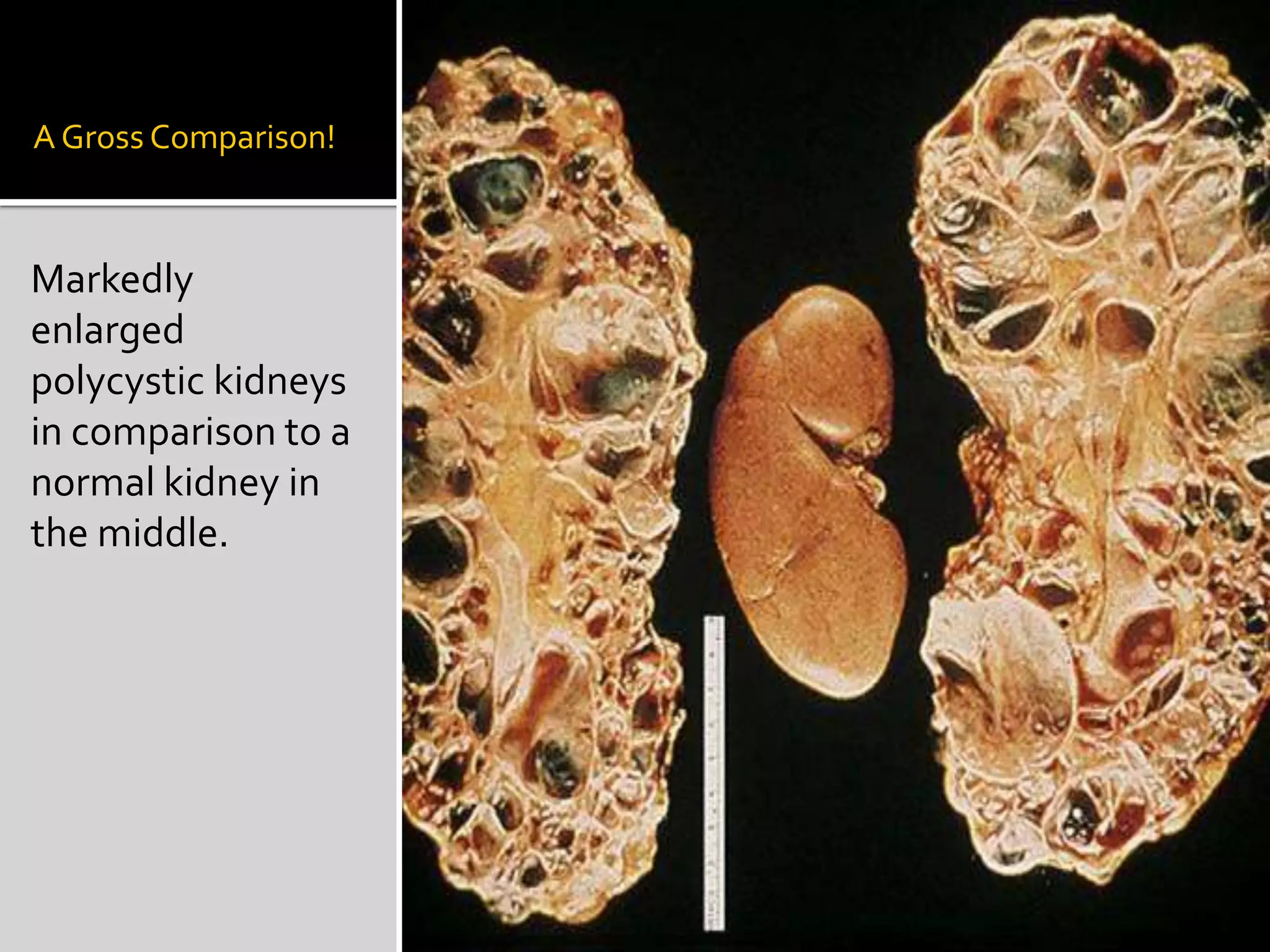 Autosomal dominant polycystic kidney disease (adpkd) | PPTX