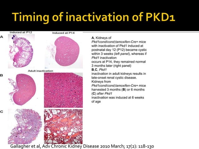 Autosomal dominant polycystic kidney disease (adpkd) | PPTX | Genetics ...