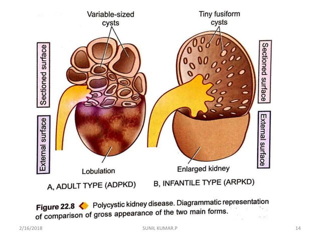 Autosomal recessive polycystic kidney disease