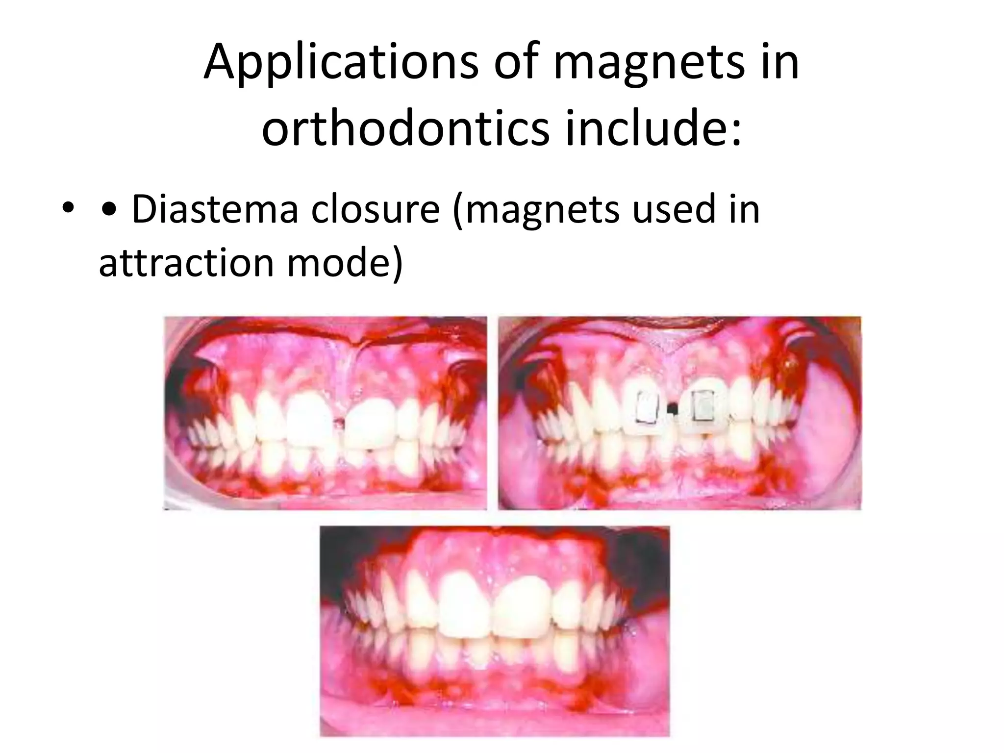 Auxiliary attachment | PPTX