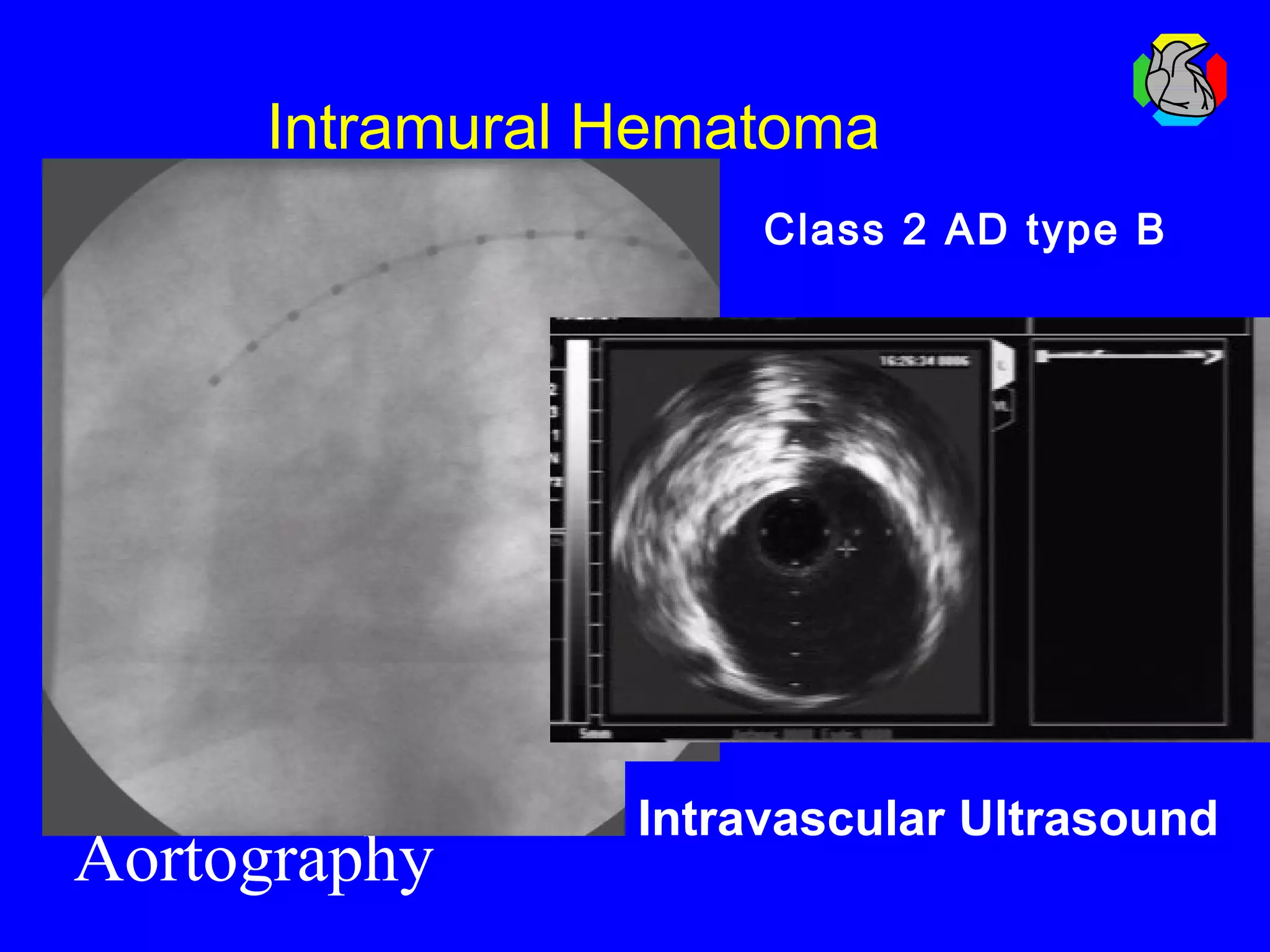 Aortic ulcer intramural hematoma aortic dissection | PPT