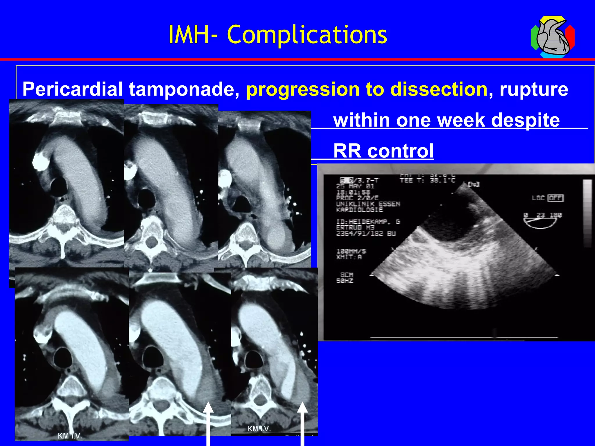 Aortic ulcer intramural hematoma aortic dissection | PPT